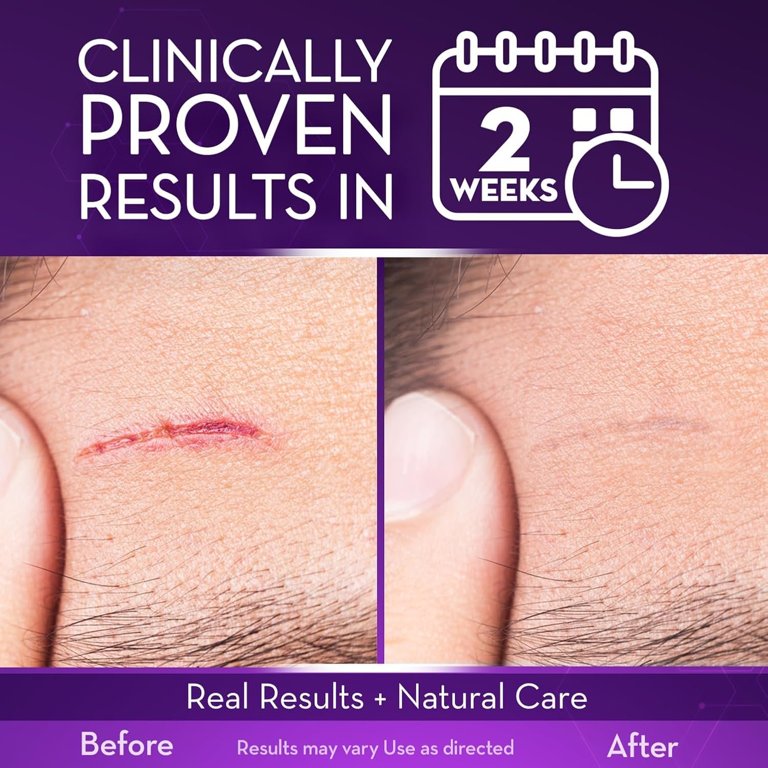 Cicatricure Advanced Scar Gel for Face & Body – Proven Results in 2 ...